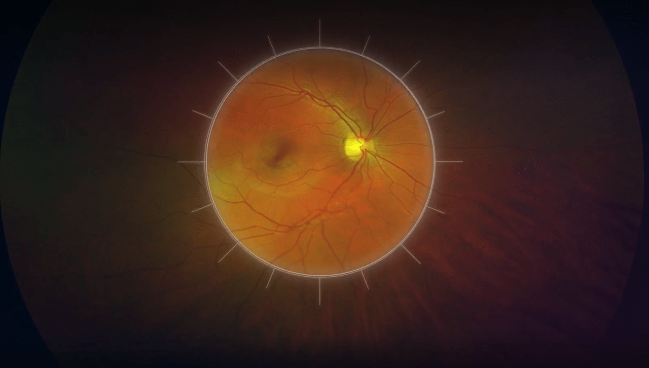 Optomap wide field eye scan
